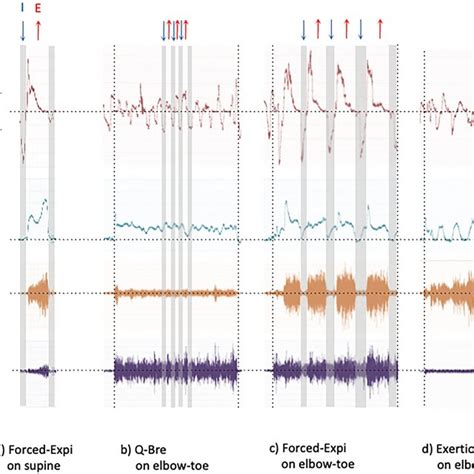 Representative Data Of Air Flow IAP And Electromyography During The