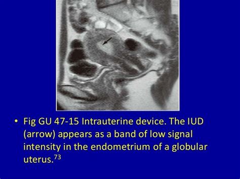 47 Diffusely Enlarged Uterus On Magnetic Resonance Imaging