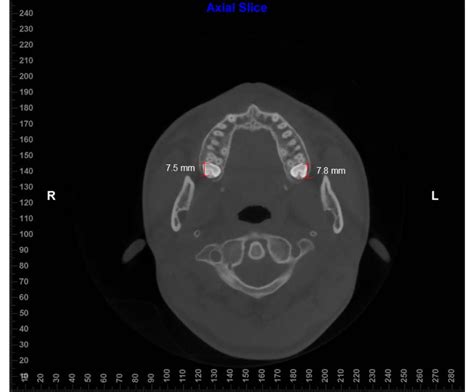 Maxillary Dentition Sequential Distalization Using Clear Aligners And