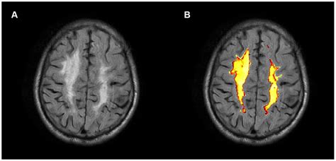 Frontiers Association Between Morphologic Features Of Intracranial