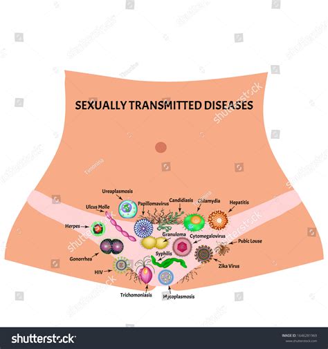 Viral Bacterial Infections Sexually Transmitted Diseases Stock Vector