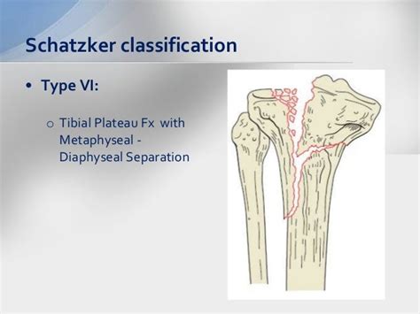 Tibial Plateau Fractures