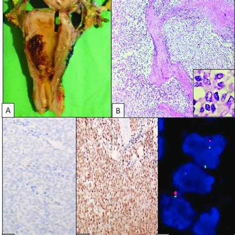 High Grade Endometrial Stromal Sarcoma A Gross Photo Polypoidal