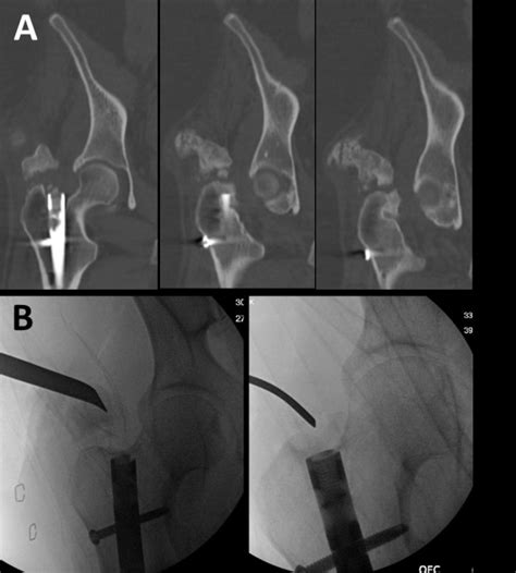 Preoperative Computed Tomography Ct Scan A And Intraoperative Download Scientific Diagram