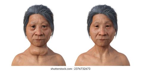Woman Graves Disease Having Enlarged Thyroid Stock Illustration