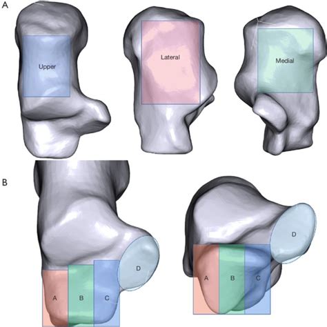 The Fracture Line Heatmap Distribution Of Group B Tongue Type Calcaneal