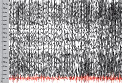 Primary Generalized Tonic Clonic Seizures Neupsy Key
