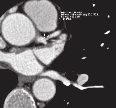A Contrast Enhanced Multislice Computed Tomography Reveals A