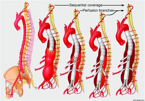 Sequential Coverage Of The Aorta With Continuous Perfusion Of The Left Download Scientific