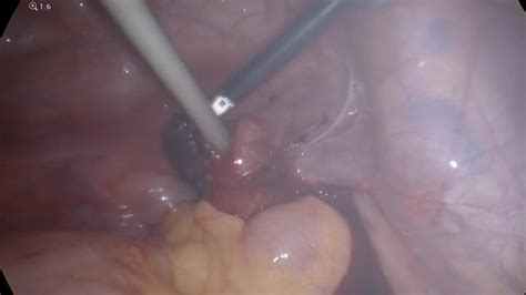 Laparoscopic Salpingostomy For Tubal Ectopic Pregnancy Surgeryu By Aagl