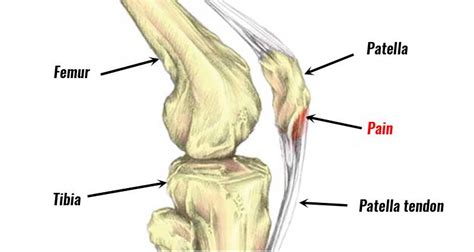 Patellar Tendonitisjumpers Knee Symptoms Causes And Treatment