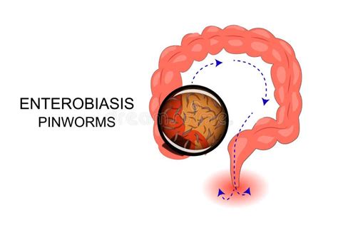 Bowel Suffering From Enterobiasis Stock Vector Illustration Of