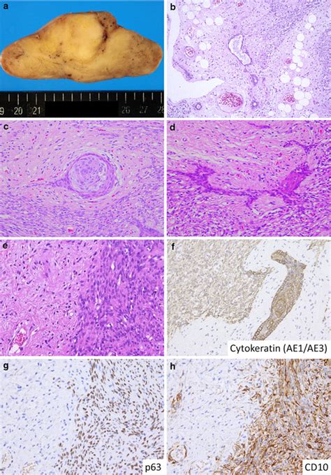 Case 1 A Grossly The Tumor Was A Well Circumscribed Yellowish Solid