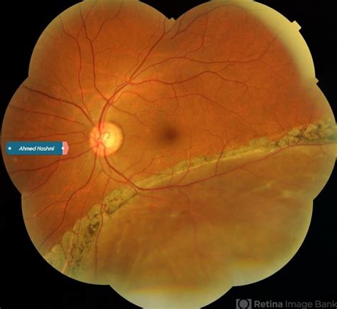 Retinal Detachment Retina Image Bank