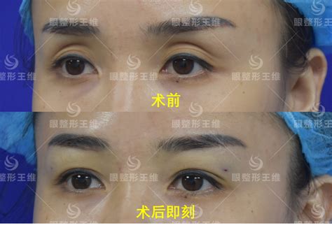 上睑凹陷填充可以用眶隔脂肪吗？ 知乎