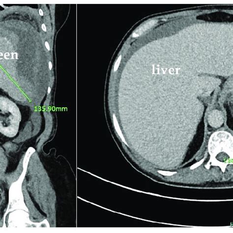 Coronal And Sagittal Plane Computed Tomography Ct Scans With Iv