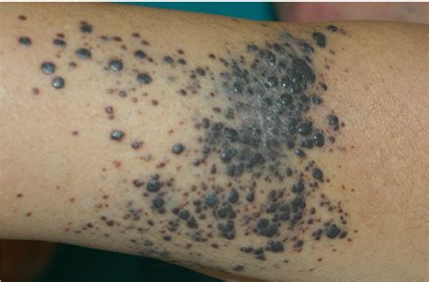 Clinical Features Of Local Recurrences That Are Defined As The Download Scientific Diagram