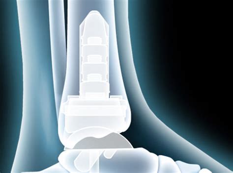 Video Total Ankle Joint Replacement Wright Inbone® Ii Healthclips