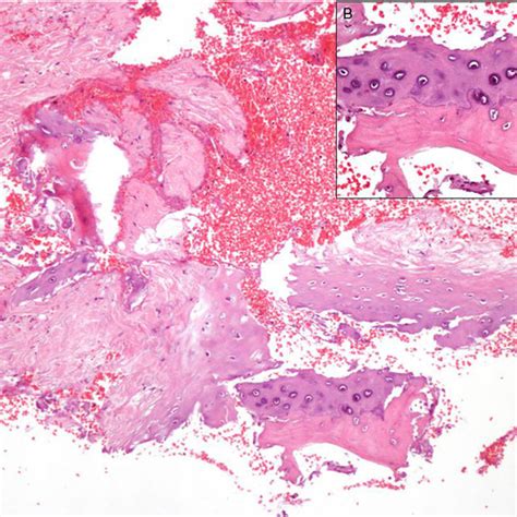A Image Shows A Superficial Diffuse Infiltrate And A Nodular