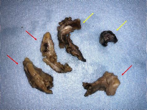 Appendicitis A Rare Adverse Event In Colonoscopy Bmj Case Reports