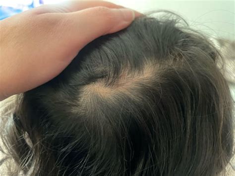 Scalp Birthmark Nevus Sebaceus R Dermatologyquestions