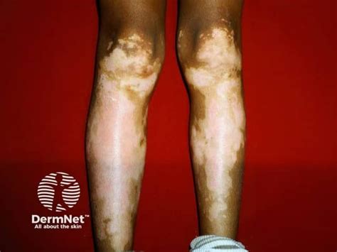 Vitiligo Images — Dermnet