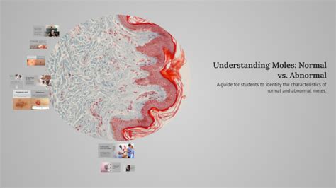 Understanding Moles Normal Vs Abnormal By Danielle Blue On Prezi