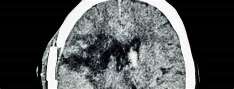 Frontal Lobe Tumor Surgery