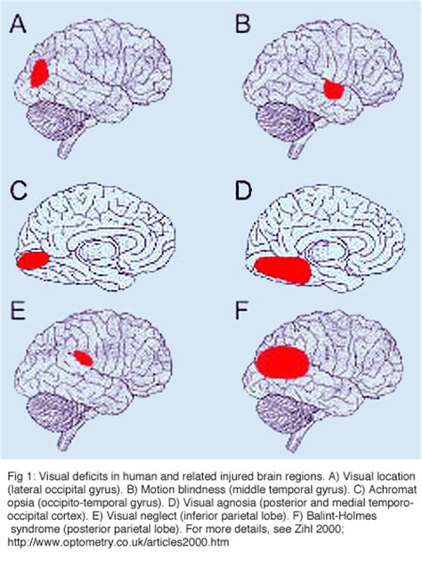 Inferior Occipital Gyrus Meddic