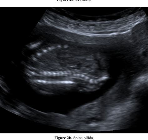 Spina Bifida 3d Ultrasound