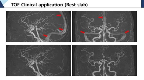 3 Entry Slice Phenomenon Youtube