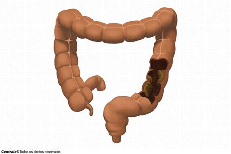 Fecaloma O Que é Isso Sinais Sintomas E Doenças Abcmed