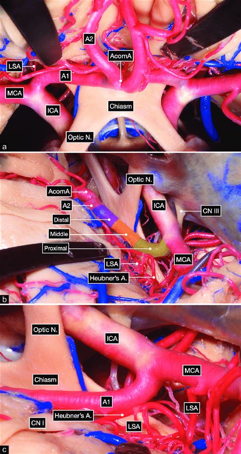 Anatomic Dissection In A Formalin Fixed And Siliconeinjected Cadaveric Download Scientific