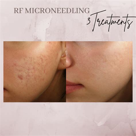 Rf Microneedling Eluma Laser And Aesthetics