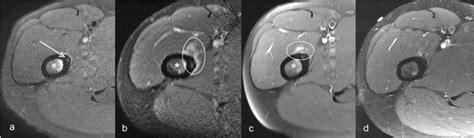 A 19 Year Old Male With Typical Biologic Pain Of Osteoid Osteoma Pain