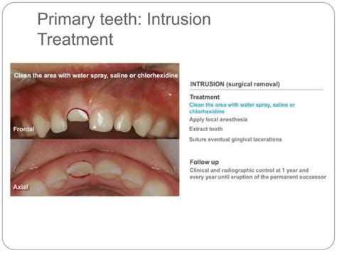 Dental Trauma To Primary Teeth