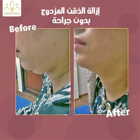 ازالة الذقن المزدوج بدون جراحة دكتور تجميل دكتور عماد فرج