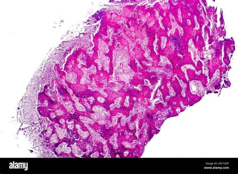 Histology Of Callus A Thickened Skin Made As A Result Of Pressure