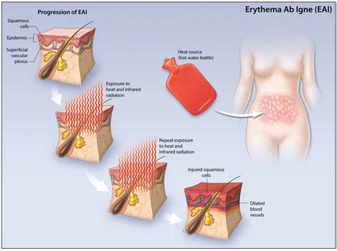 Erythema Ab Igne