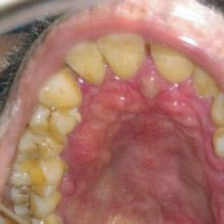 Evidence Of Diffuse Proliferative Soft Tissue Swelling In The Region