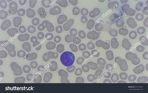 Atypical Lymphocytes Dengue
