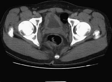 Computed Tomography Showing Irregular Bladder Outline With Download Scientific Diagram