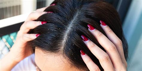 Causes Of Dandruff How To Treat Them YourTango
