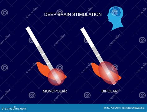 Deep Brain Stimulation For Treatment Of Parkinson Disease Vector Illustration Cartoondealer
