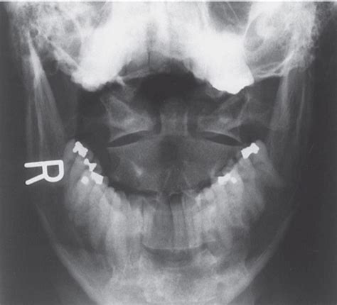 Open Mouth Ap Odontoid Diagram Quizlet