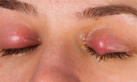 Eye Flu Symptoms Causes And Effective Remedies Kamri Rasoi