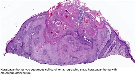 Squamous Cell Carcinoma Biopsy My Xxx Hot Girl