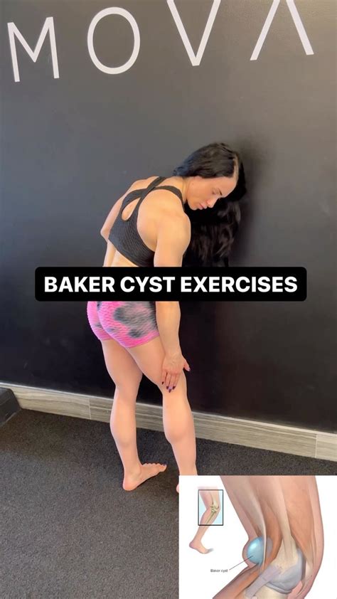 Exercises For Bakers Cyst
