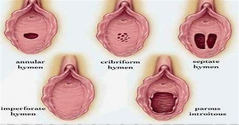 Facts About The Hymen And Virginity