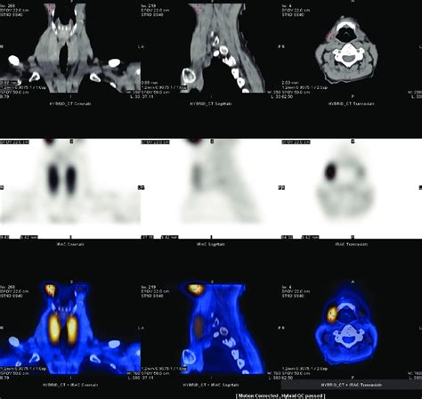 A 74 Year Old Woman With Primary Hyperparathyroidism Spect Ct In Download Scientific Diagram
